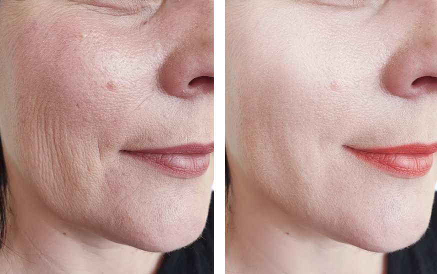 Collagen wave Skin Tightening at Harmony Beauty Clinic Dunstable